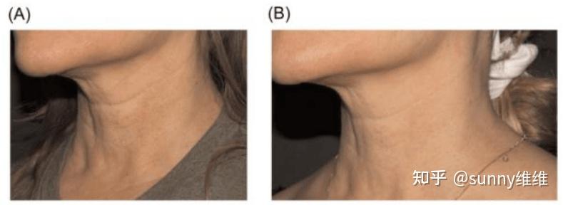 BBL PLUS到底做了哪些史诗级革新？一次说明白 - 知乎