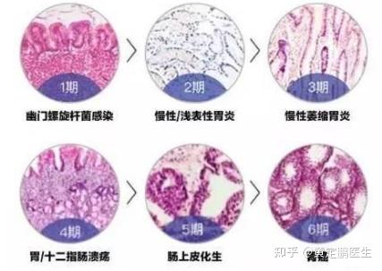 胃肠镜医生黄定鹏：胃部发生肠上皮化生的原因有哪些？ - 知乎