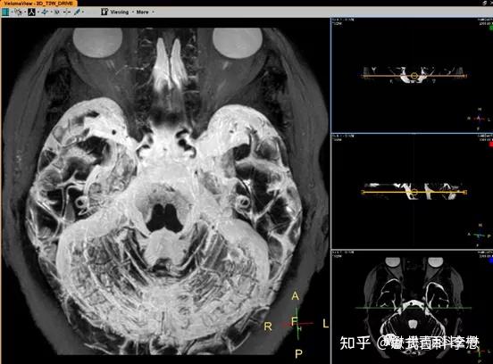 MRI内听道神经及周围血管成像扫描规范（MRTA、IAC） - 知乎