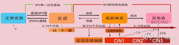 宫颈癌是怎样发展而来的？ 知乎