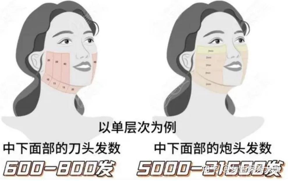 黄金超声炮和半岛超声炮什么区别~知识点都在这里了~ 知乎
