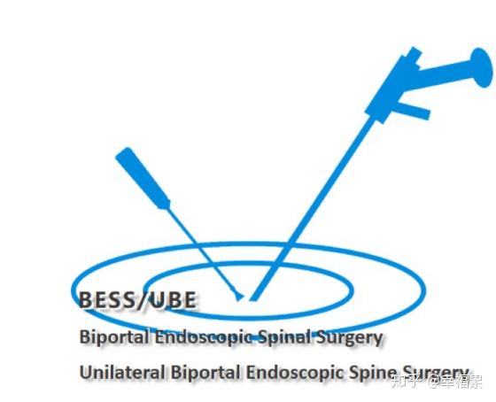 韩国神经外科专家许东华教授谈：Biportal endoscopic - TLIF视频】UBE介绍】 - 知乎
