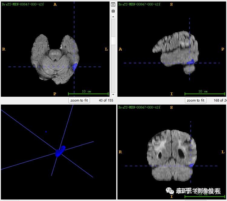 BraTS2023-MEN——BraTS2023颅内脑膜瘤分割挑战赛 - 知乎
