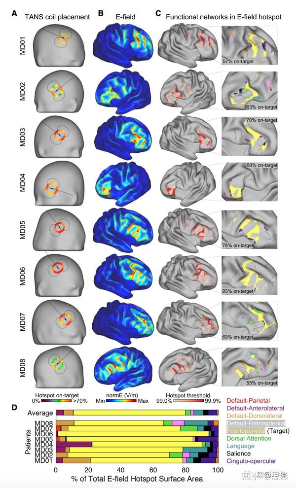 Neuron：自动优化TMS线圈放置，实现个性化靶向功能网络刺激 - 知乎