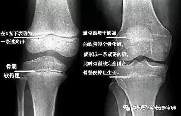 为啥18岁以后还能长高?突破遗传身高的关键到底是啥? 知乎