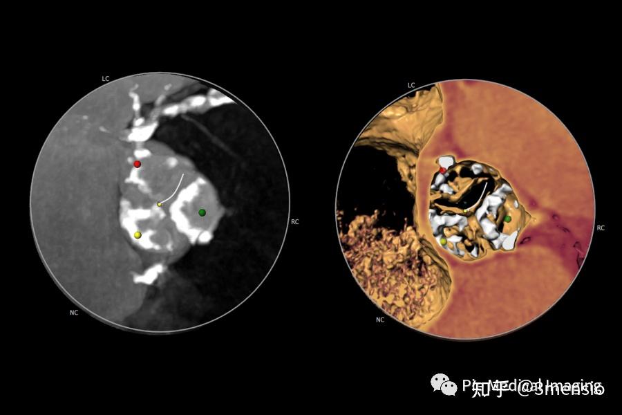 3mensio Aortic - 知乎