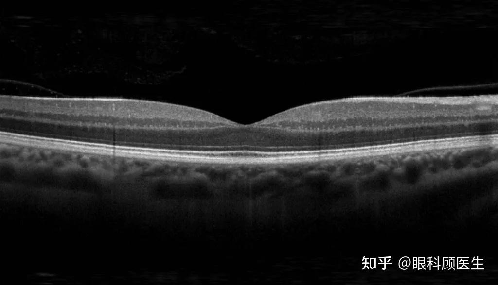 什么是OCT检查？ - 知乎