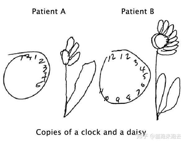 被嫌弃的左半边 丨 半侧空间忽略症患者的视野 - 知乎
