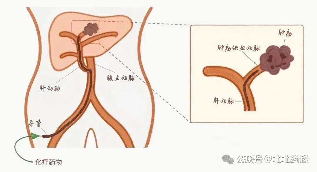 肝癌治疗中的HAIC、TACE，如何选择，优缺点各是啥？ - 知乎