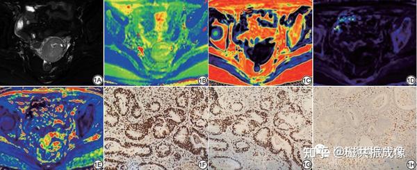 T2 mapping联合mDixon-Quant多参数成像评估子宫内膜癌MSI的研究 - 知乎