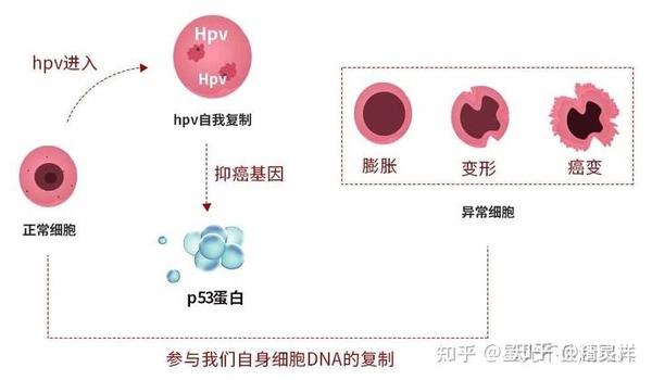 Cin1级怎么治疗，cin1级能自愈的吗？ - 知乎