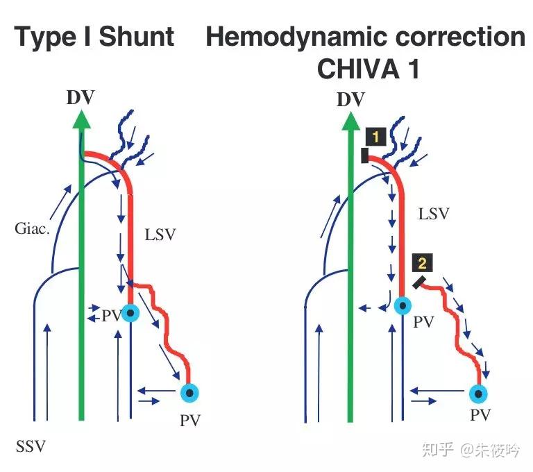 CHIVA治疗下肢静脉曲张：优势与结果 - 知乎