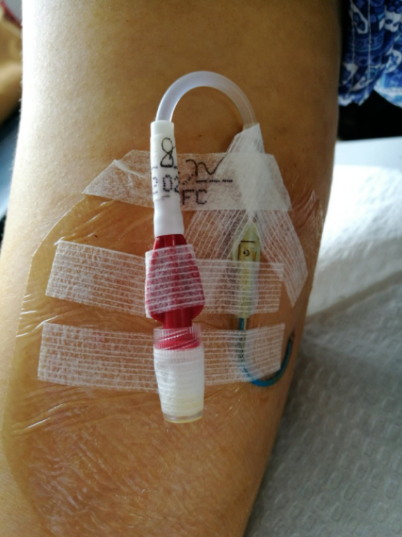PICC、CVC、输液港如何选择？ - 知乎