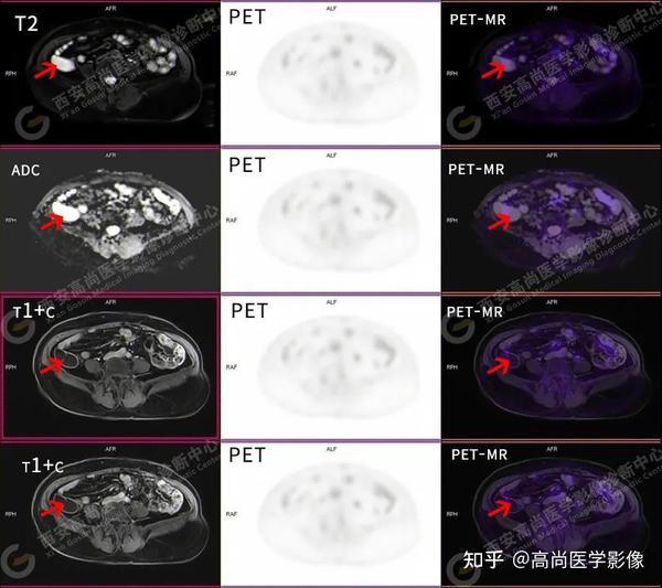18F-FDG PET/CT-MR多模态诊断阑尾粘液性肿瘤病例【高尚医学影像】 - 知乎