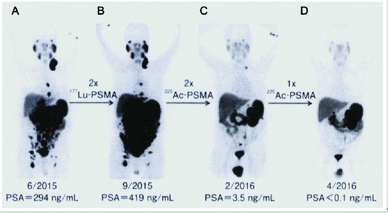 FDA批准首个PSMA靶向PET成像药物用于前列腺癌患者 - 知乎