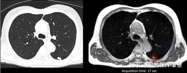MRIdian Linac 磁共振引导放疗系统介绍 - 知乎