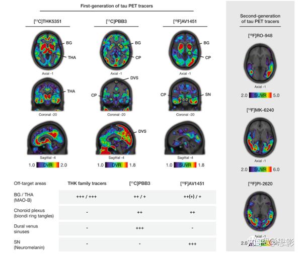 Tau PET成像在神经退行性Tau病中的应用—仍然是一个挑战 - 知乎