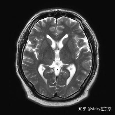 脑中风的预防与脑健康检查（脑部MRI/MRA） - 知乎
