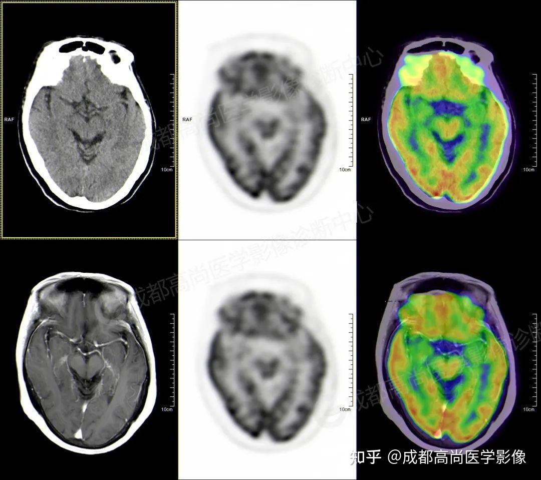 【高尚病例】PET-CT/MRI多模态检查实现“一站式”诊断 - 知乎