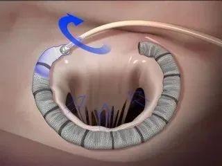 三尖瓣反流丨经导管 瓣环成形术修复器械 - 知乎