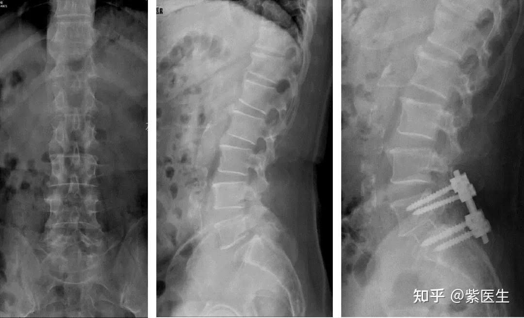 定量CT（QCT）是什么？临床应用有哪些？ - 知乎