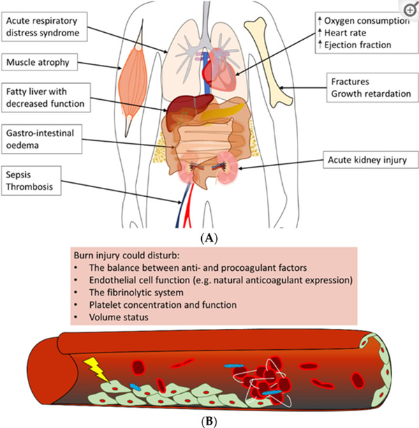 烧伤后免疫反应的复杂性：相关局部和全身并发症综述4 身材总监医学烧伤压力衣定制&烧伤康复中心 - 知乎