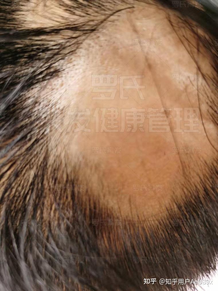 罗缔发域答疑为什么斑秃恢复期长出来头发是白色的? 知乎