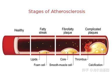 心脑血管疾病的“指南针”——脂蛋白相关磷脂酶A2(Lp-PLA2) - 知乎