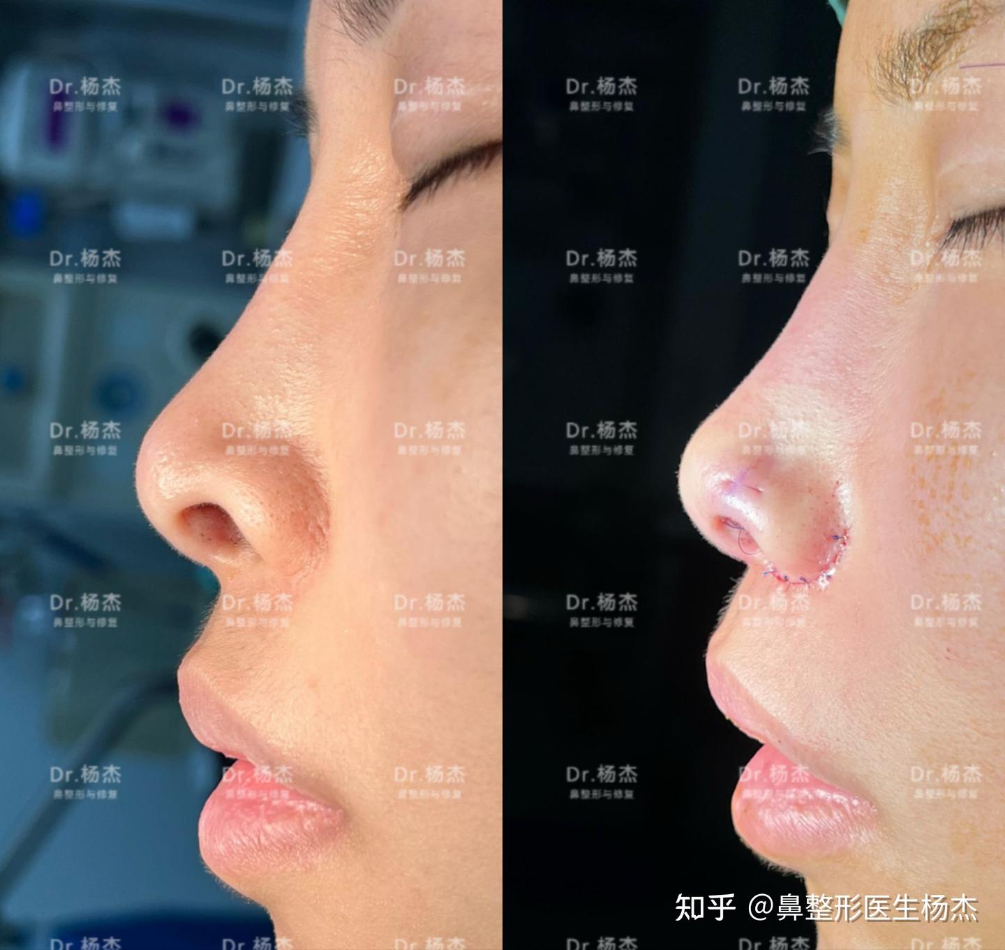 【ACRS模式露鼻孔综合修复+鼻槛上提】 - 知乎