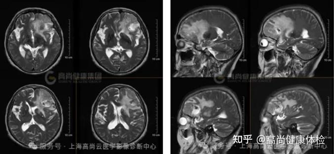 高级别胶质瘤 - 知乎
