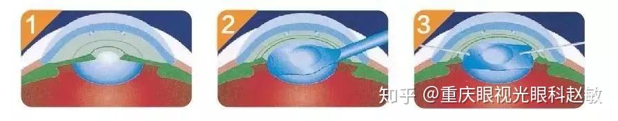 ICL检查手术全流程攻略 - 知乎