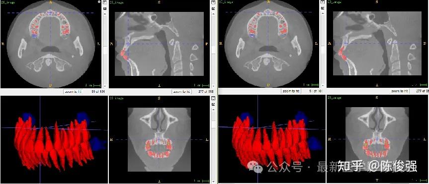 STSR2025——CBCT牙齿分割和CBCT与IOS注册配准 - 知乎