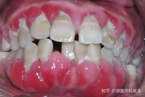 牙龈萎缩了,能再恢复吗 知乎