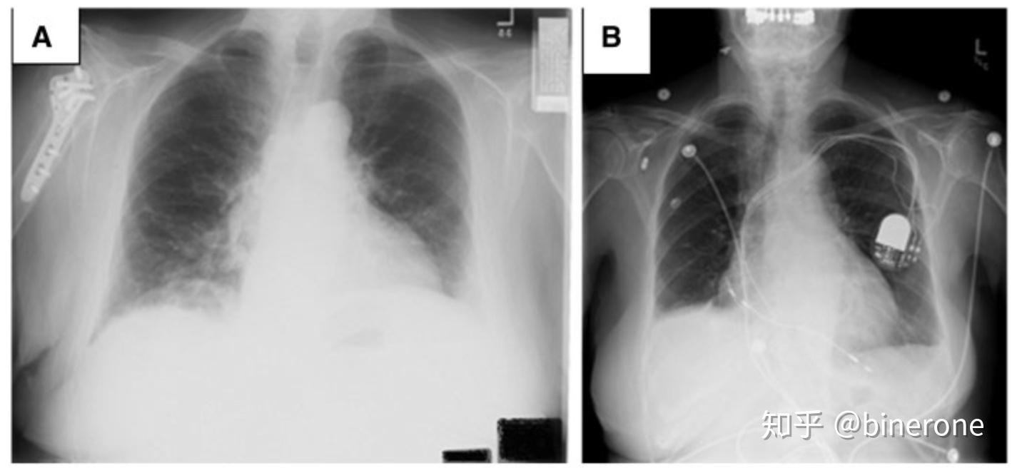【IU-XRay】医疗诊断报告生成数据集 - 知乎