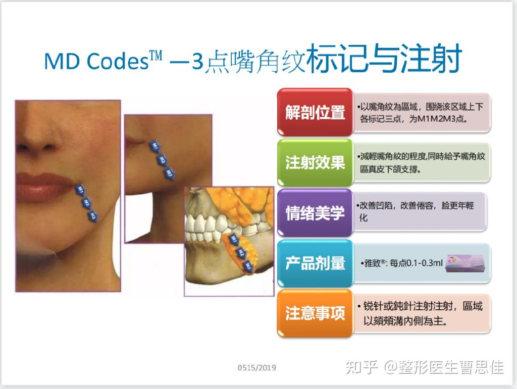 MD Codes 注射法，我为什么不教！ - 知乎