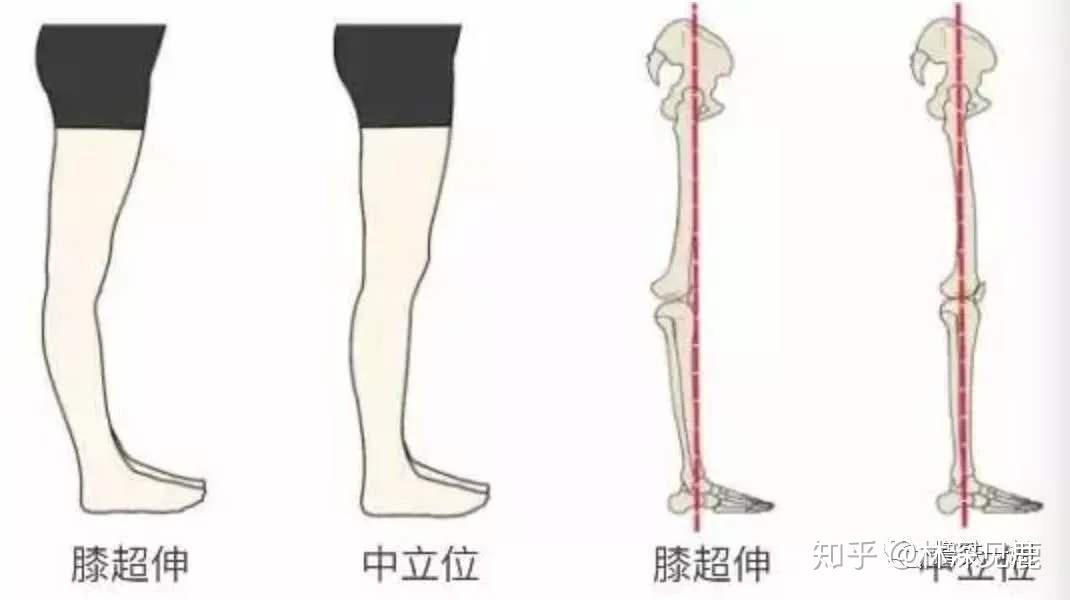 如何矫正大腿向前倾小腿往后凸的腿型？ - 知乎