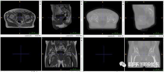 SynthRAD2023——放射治疗的CT合成 - 知乎