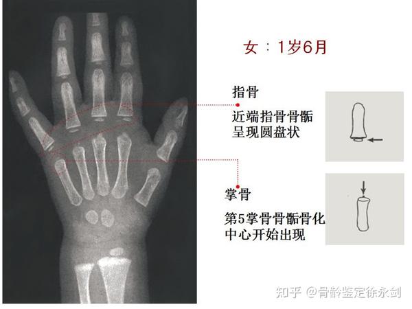 详解骨龄标准g P骨龄图谱法（女孩版） 知乎