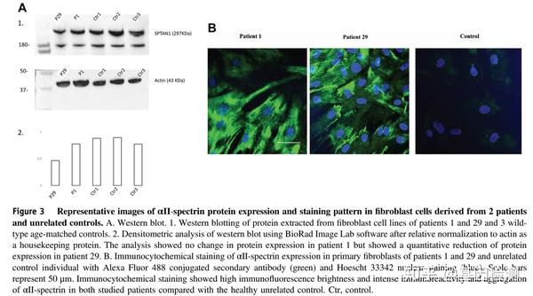 SPTAN1单等位变异相关疾病延申:从癫痫性脑病到单纯痉挛性截瘫和共济失调 - 知乎