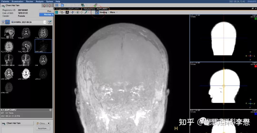 颅脑静脉MRV规范化扫描及临床应用 - 知乎