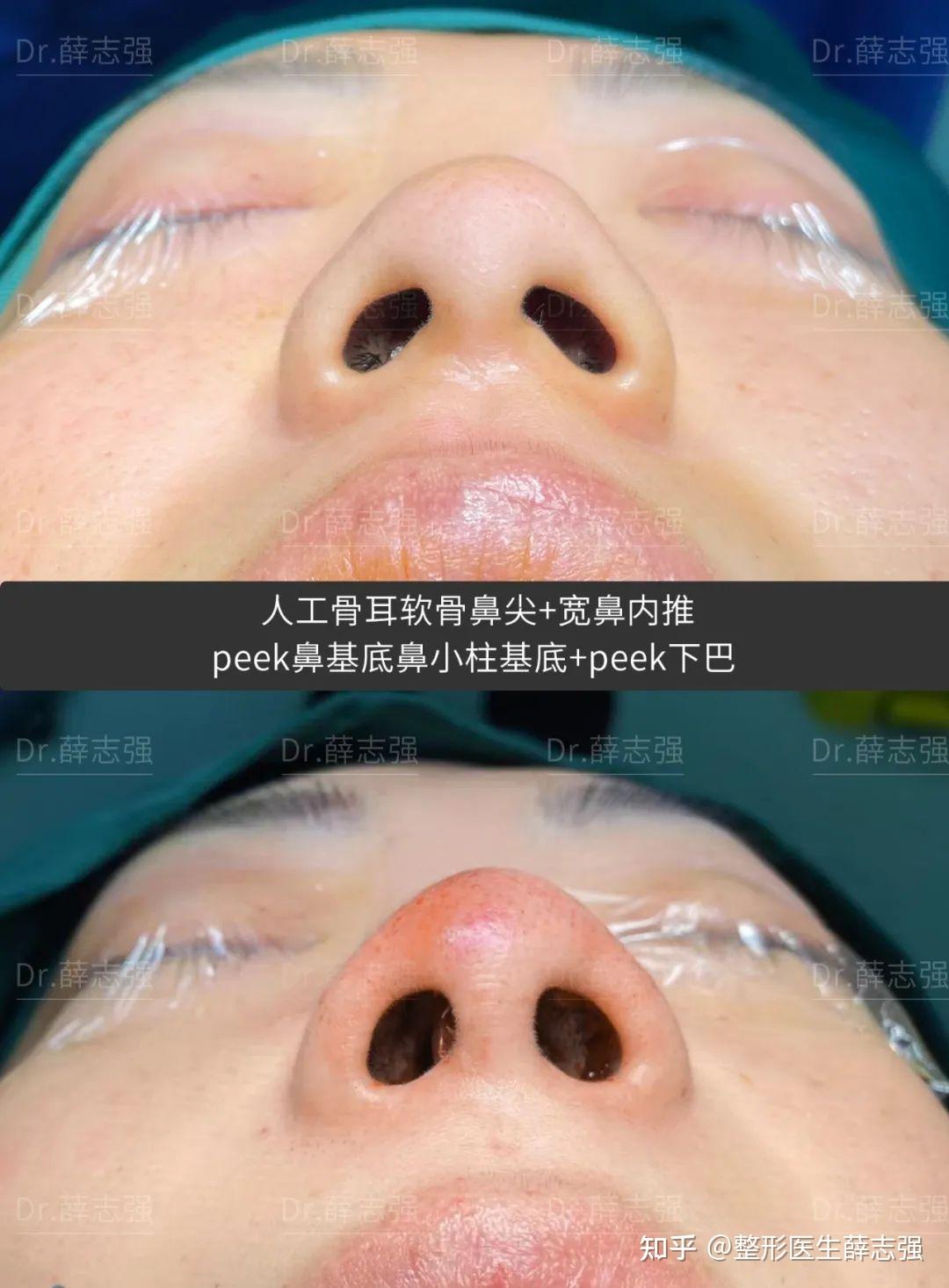 3D打印数字化定制丨Peek鼻基底+Peek下巴 - 知乎