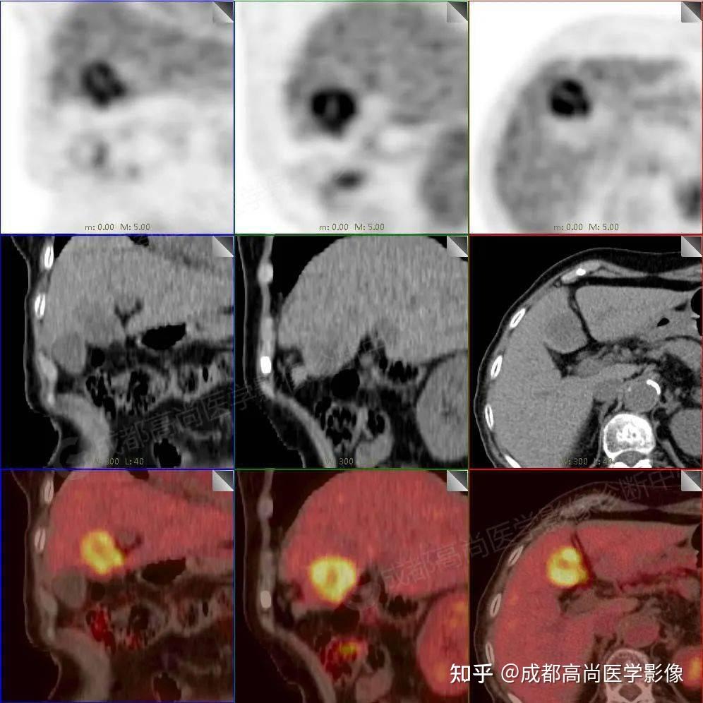 【高尚病例】PET/CT诊断结肠癌1例 - 知乎