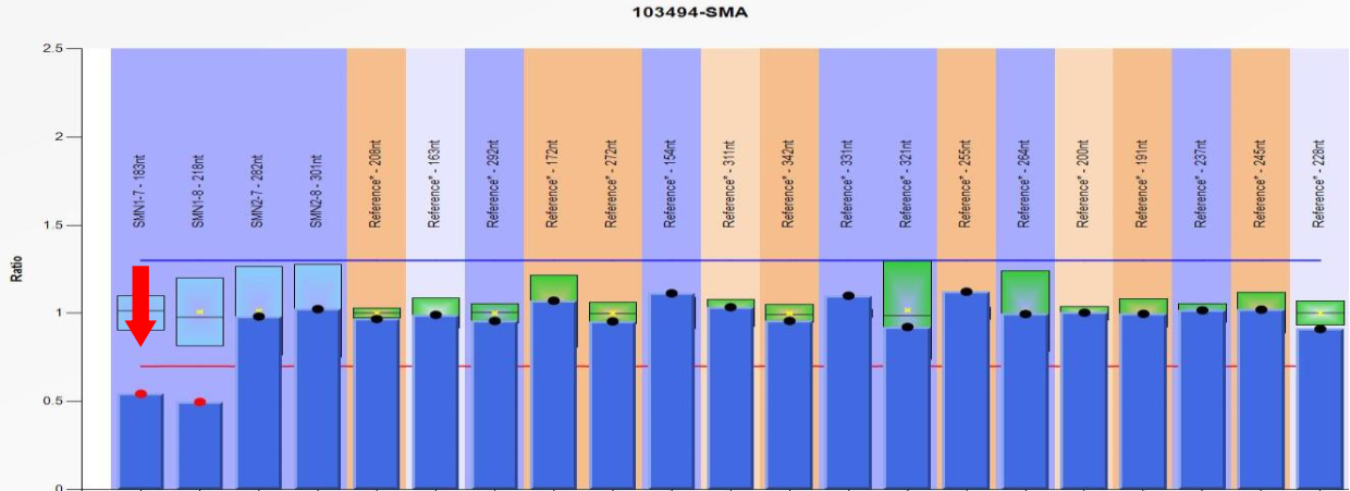 案例分享 | 基因检测辅助诊断遗传病——脊髓性肌萎缩症(SMA) - 知乎