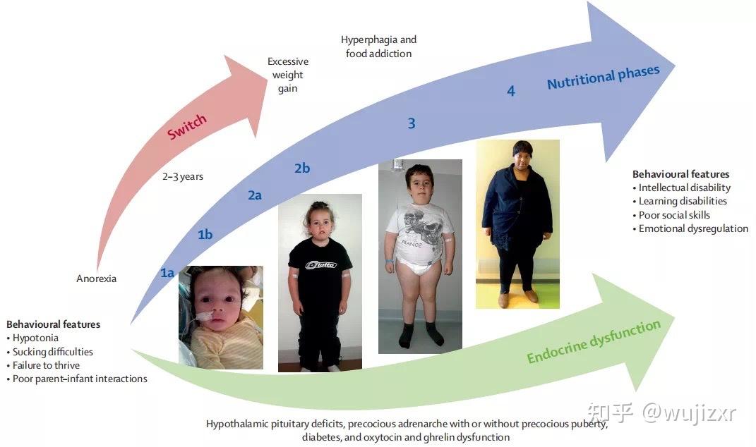 小胖威利综合征（PRADER-WILLI SYNDROME; PWS）那些事儿 - 知乎