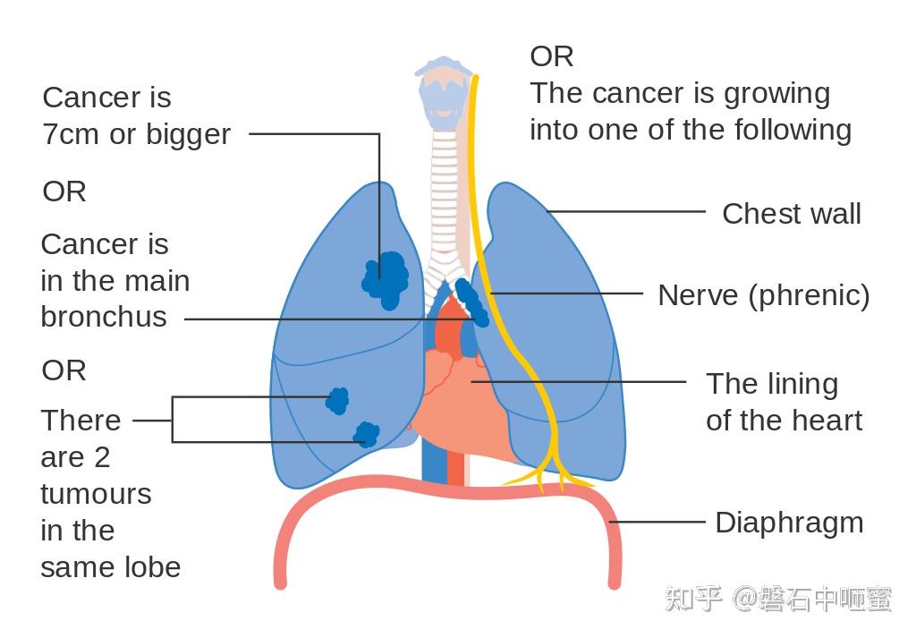 肺癌 Lung cancer - 知乎