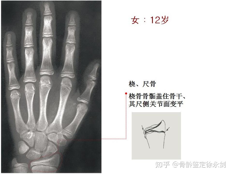 详解骨龄标准g P骨龄图谱法(女孩版) 知乎