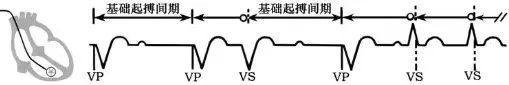 临时起搏器起搏模式VVI/AAI/VOO/AOO - 知乎