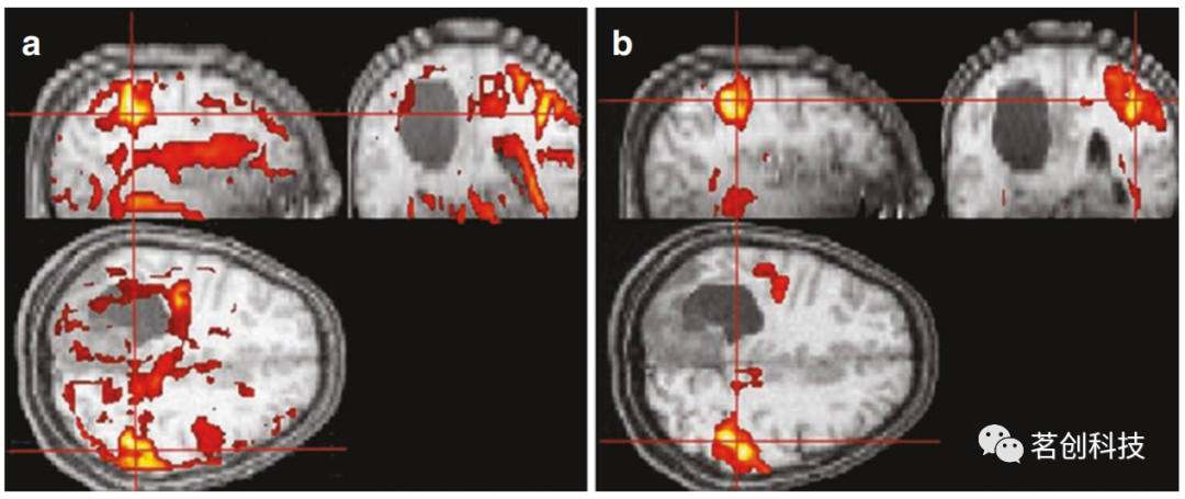 BOLD fMRI和DTI：伪影、技巧和诀窍 - 知乎