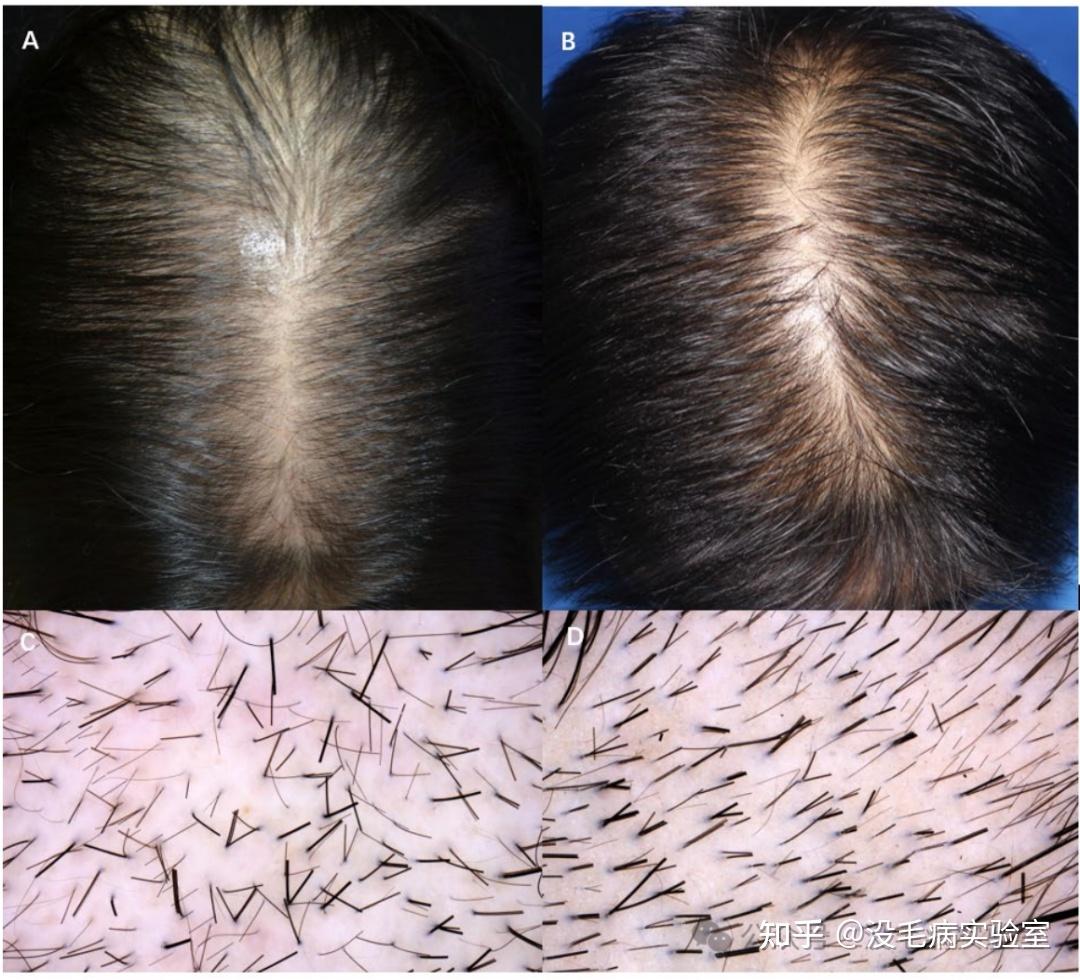 美国皮肤病学会JAAD：PRP+微针+米诺地尔攻克重度难治性脱发！ - 知乎