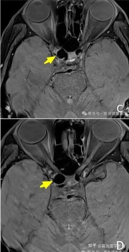 高分辨磁共振血管壁成像（HRMR-VWI）-学术荟萃系列专题 - 知乎
